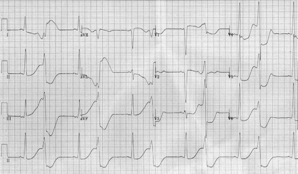 Topic - Special Types of Premature Ventricular Contractions | 12 Lead ...