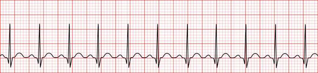 Topic - Pediatric Tachycardia with a Pulse | PALS Course | ACLS ...