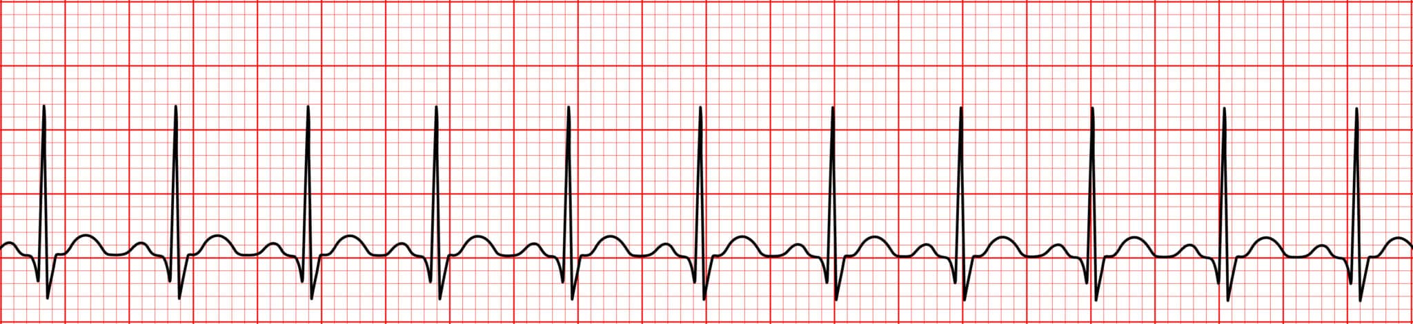 Topic - Pediatric Tachycardia with a Pulse | PALS Course | ACLS ...