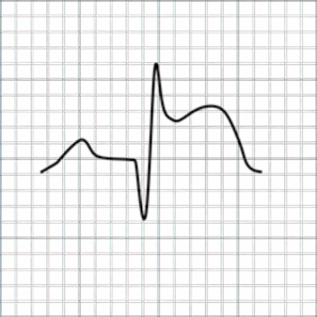 Topic - Electro Pathophysiology | 12-Lead ECG Certification Course ...