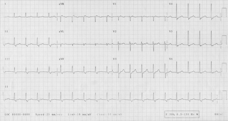 Topic - Conduction in Atrioventricular Nodal Reentrant Tachycardia | 12 ...