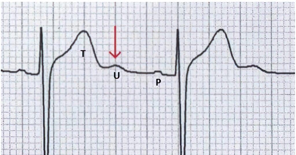 Topic - T waves and U waves | 12-Lead ECG Certification Course | ACLS ...