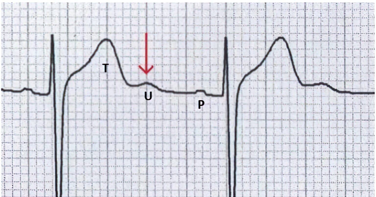 Topic - T waves and U waves | 12-Lead ECG Certification Course | ACLS ...