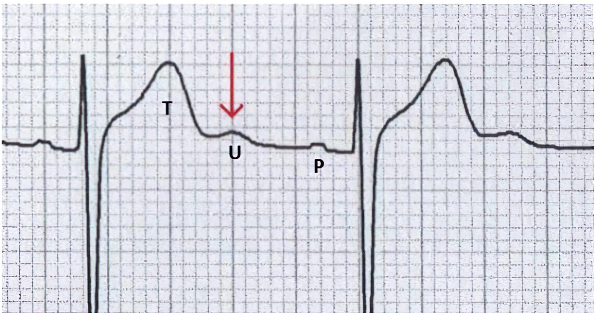 Topic - T waves and U waves | 12-Lead ECG Certification Course | ACLS ...