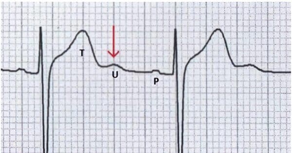 Topic - T waves and U waves | 12-Lead ECG Certification Course | ACLS ...