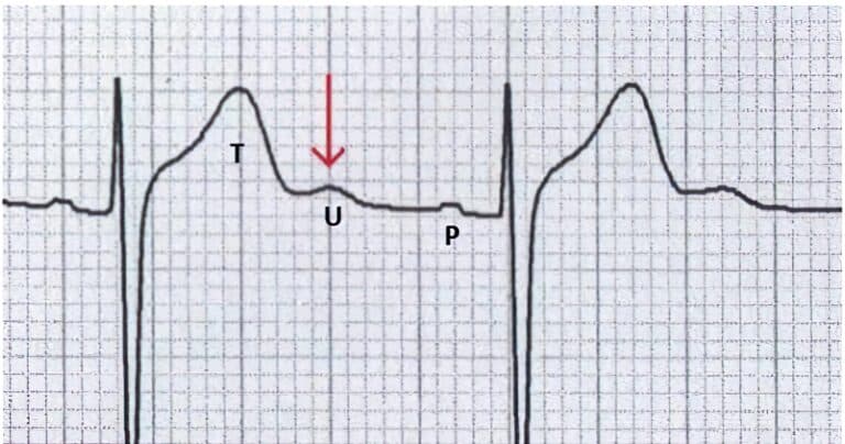 Topic - T waves and U waves | 12-Lead ECG Certification Course | ACLS ...