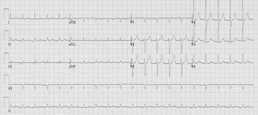 Topic - Atrial Tachycardias | 12-Lead ECG Certification Course | ACLS ...