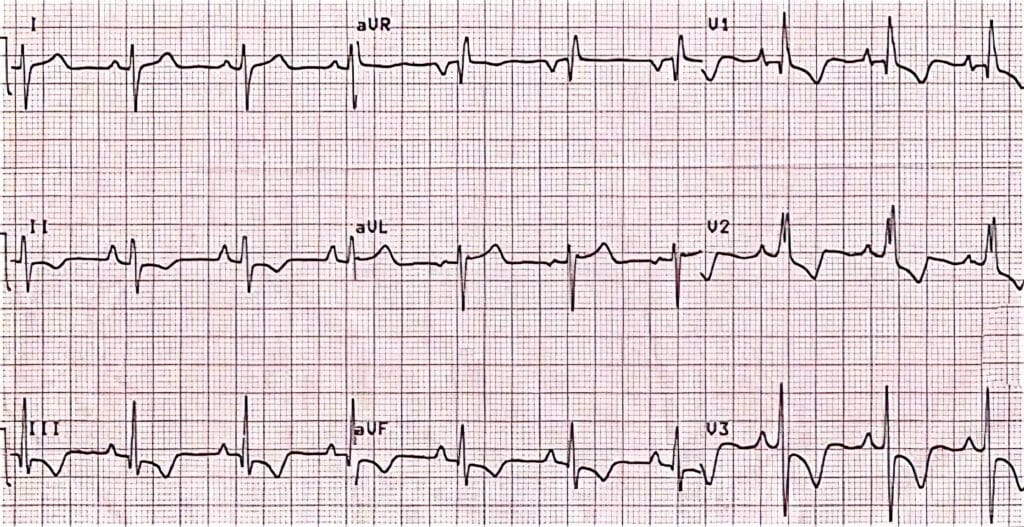 Topic - Right Ventricular Hypertrophy - Exercises | 12-Lead ECG ...