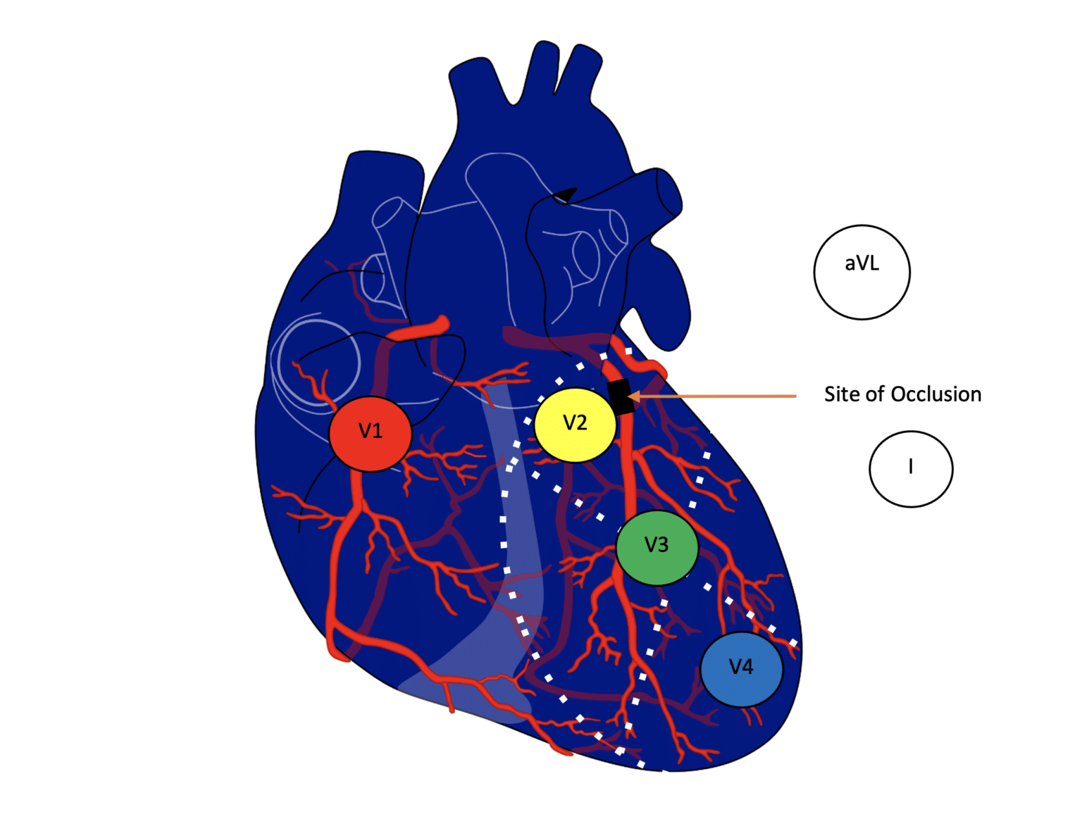 Topic - Localization of Q Wave Infarction | 12-Lead ECG Certification ...