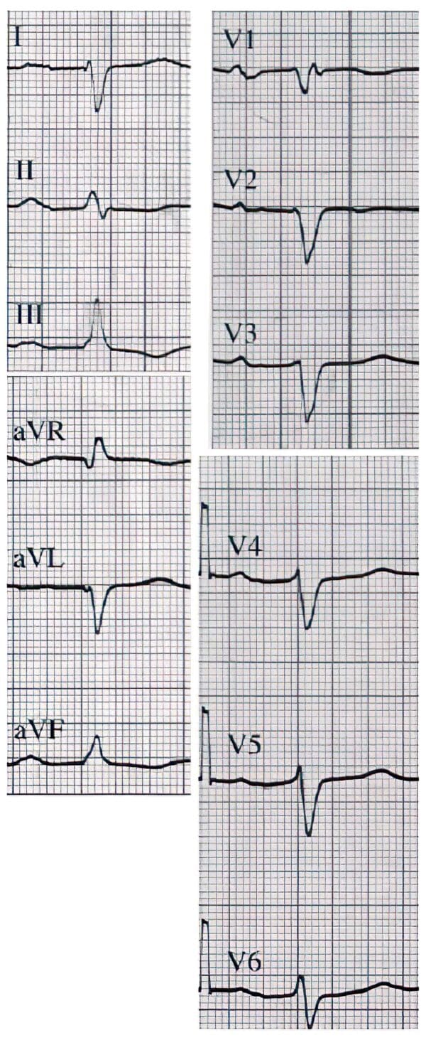 Topic - Electrocardiographic Findings | 12 Lead ECG Course | ACLS ...