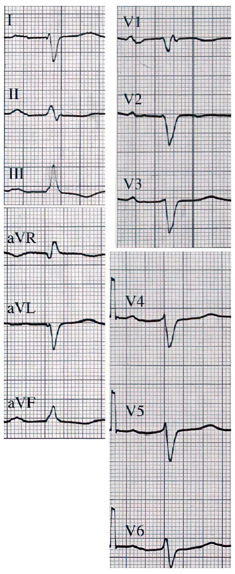 Topic - Electrocardiographic Findings | 12 Lead ECG Course | ACLS ...