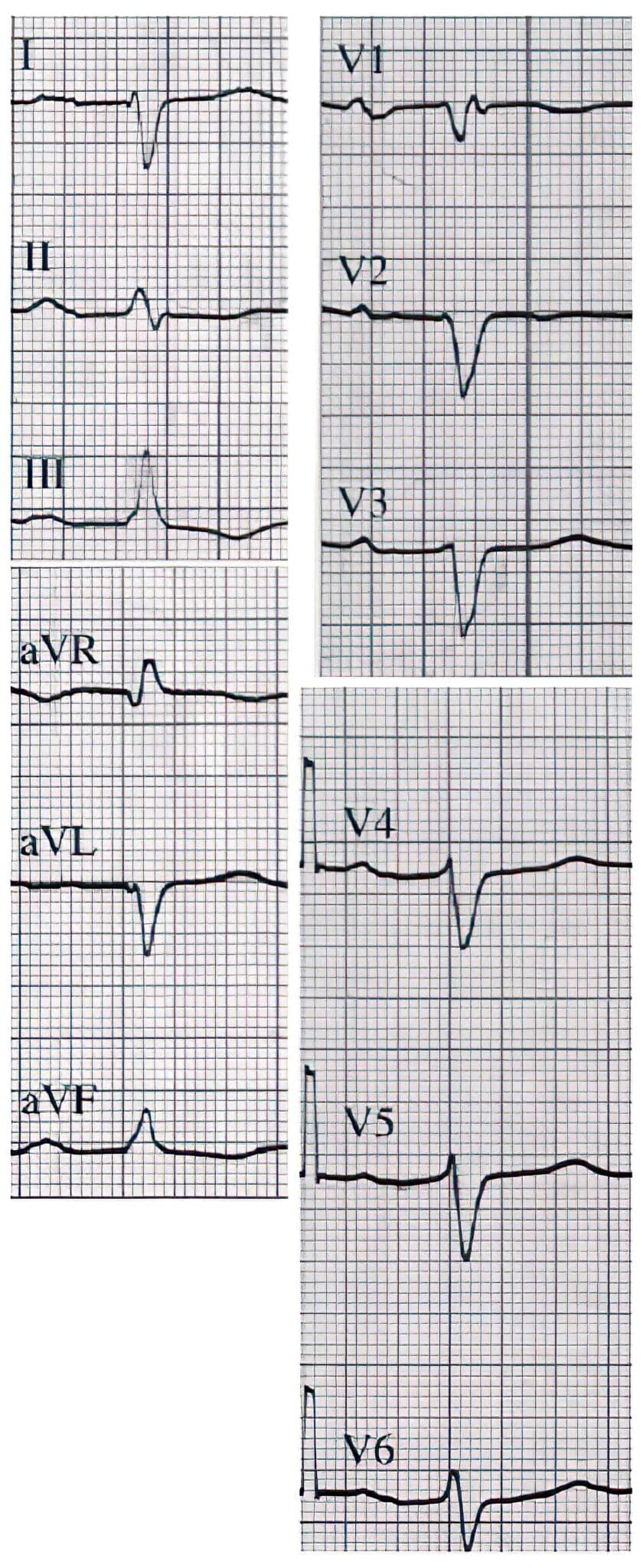 Topic - Electrocardiographic Findings | 12 Lead ECG Course | ACLS ...