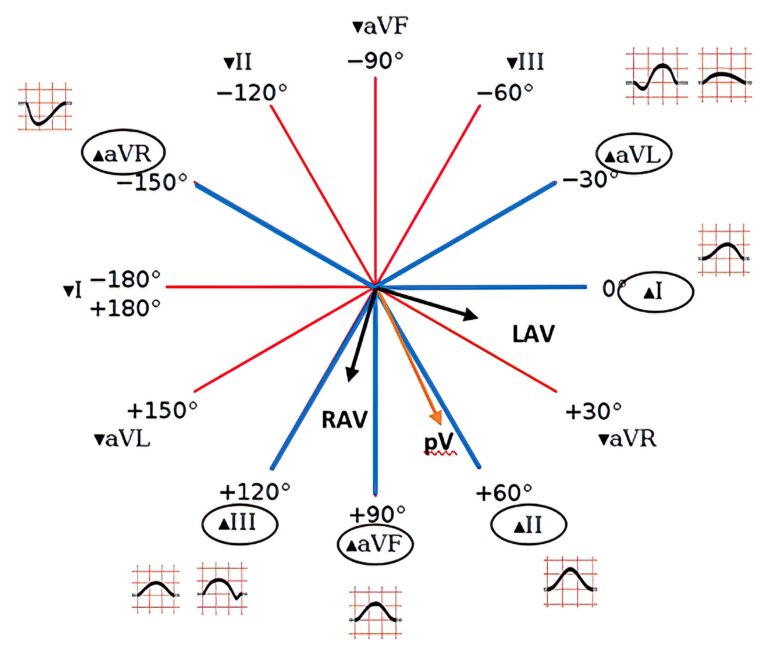 Topic - P Wave | 12-Lead ECG Certification Course | ACLS Certification ...