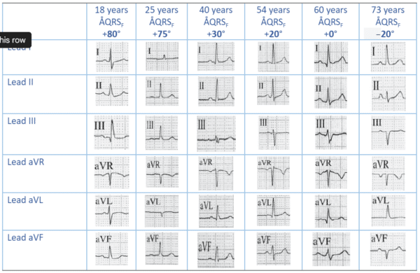 Topic - The QRS Complex | 12-Lead ECG Certification Course | ACLS ...