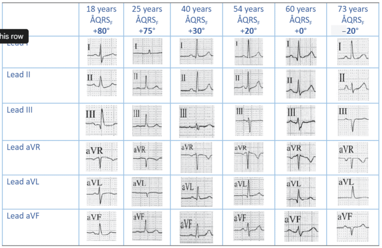 Topic - The QRS Complex | 12-Lead ECG Certification Course | ACLS ...