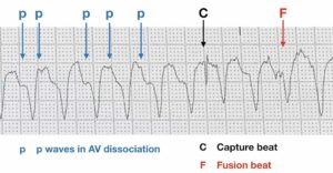 Topic - Types of Ventricular Tachycardia | 12 Lead ECG Course | ACLS ...