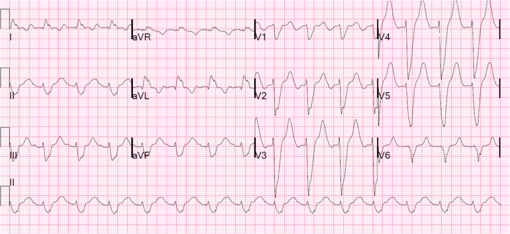 Topic - Rhythm Analysis | 12-Lead ECG Certification Course | ACLS ...