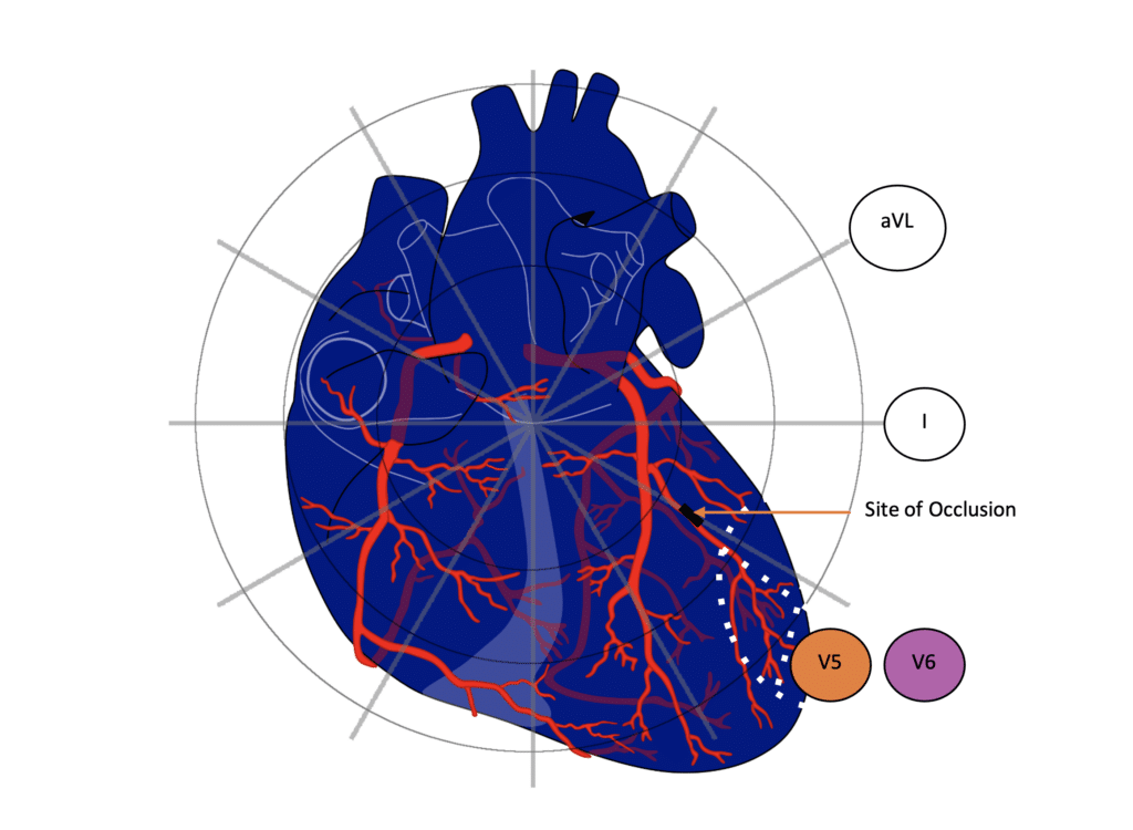 Topic - Localization of Q Wave Infarction | 12-Lead ECG Certification ...