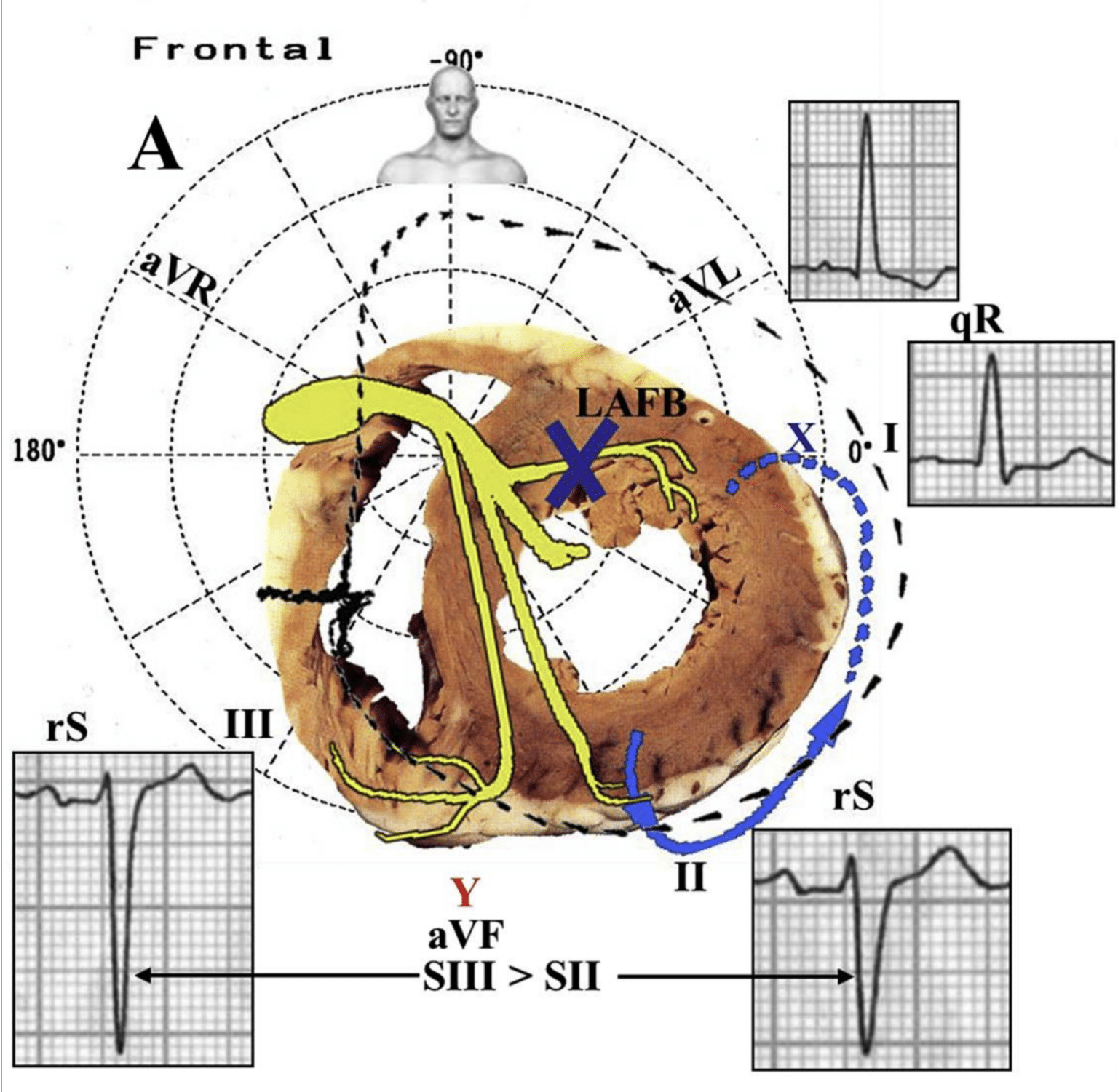 Topic - Left Anterior Fascicular Block | 12-Lead ECG Certification ...
