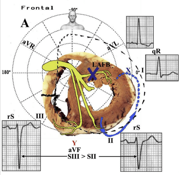 Topic - Left Anterior Fascicular Block | 12-Lead ECG Certification ...