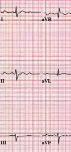 Topic - The Cardiac Axis | 12 Lead ECG Course | ACLS Certification ...