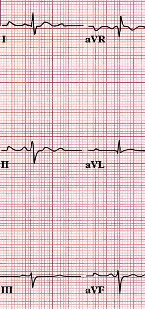Topic - The Cardiac Axis | 12 Lead ECG Course | ACLS Certification ...