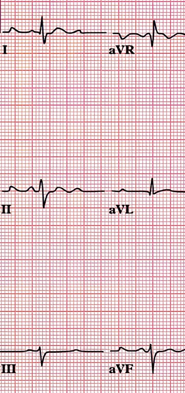 Topic - The Cardiac Axis | 12 Lead ECG Course | ACLS Certification ...