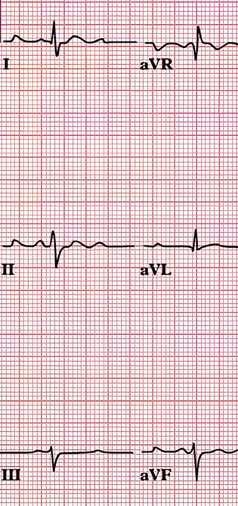 Topic - The Cardiac Axis | 12 Lead ECG Course | ACLS Certification ...