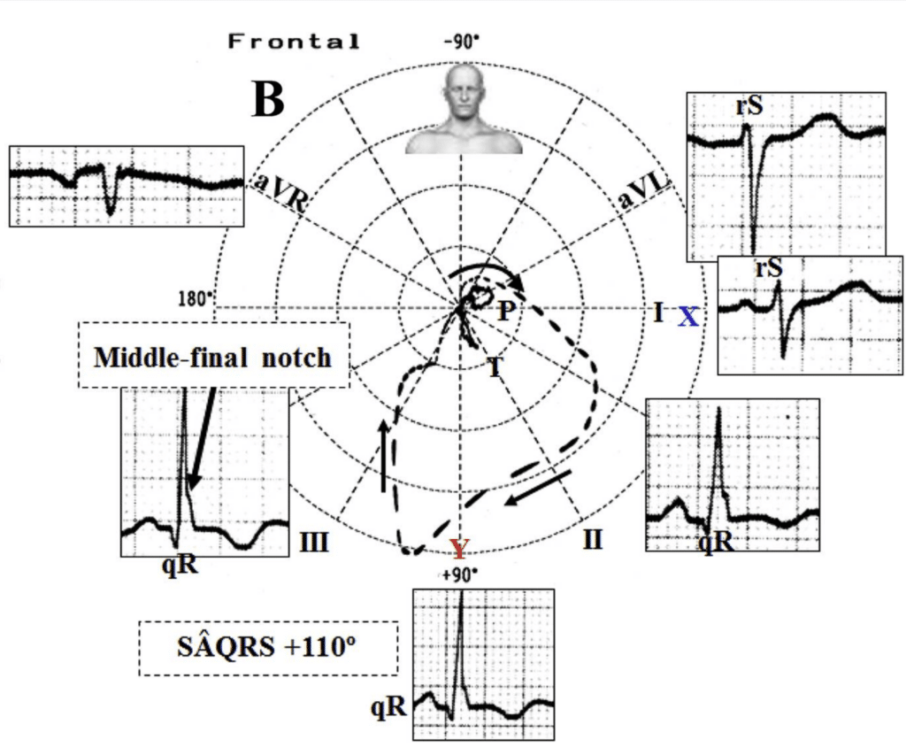 Topic - Left Posterior Fascicular Block | 12-Lead ECG Certification ...