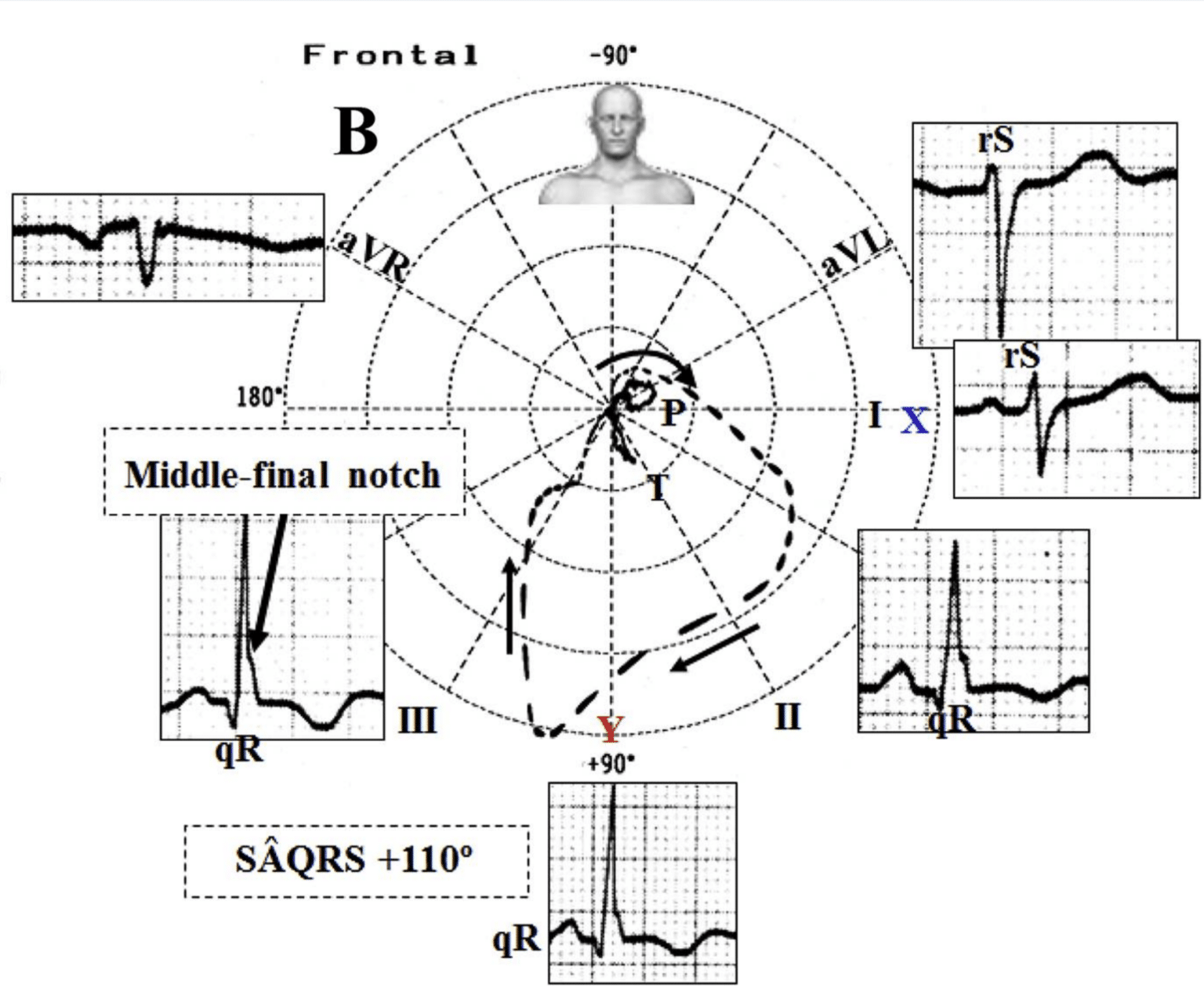 Topic - Left Posterior Fascicular Block | 12-Lead ECG Certification ...