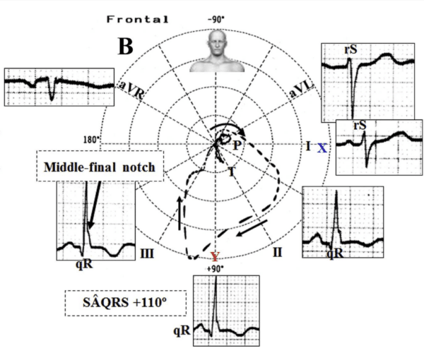 Topic - Left Posterior Fascicular Block | 12-Lead ECG Certification ...