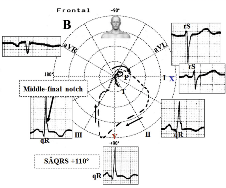 Topic - Left Posterior Fascicular Block | 12-Lead ECG Certification ...