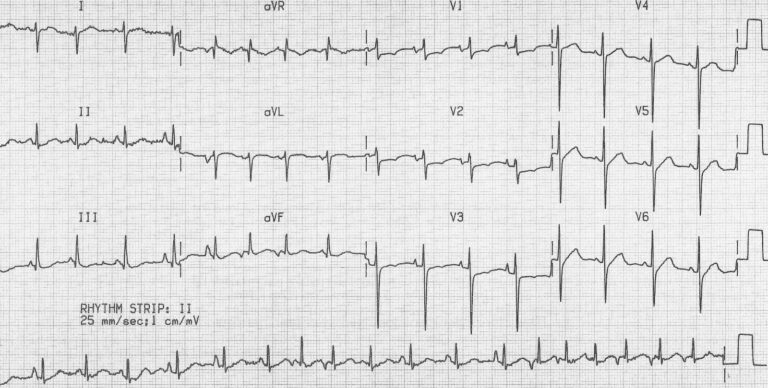 Topic - Atrial Tachycardias | 12-Lead ECG Certification Course | ACLS ...