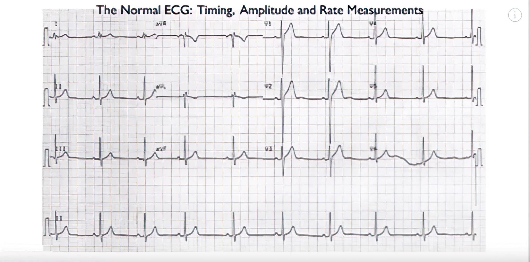 Topic - Rhythm Analysis | 12-Lead ECG Certification Course | ACLS ...