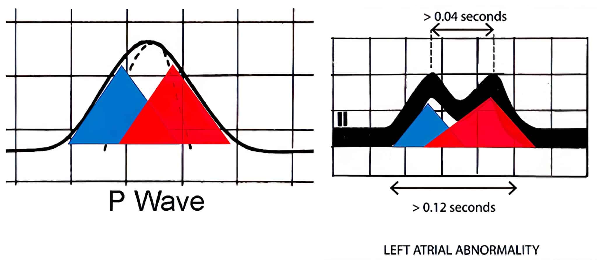 Topic - Left Atrial Enlargement / P Mitrale | 12-Lead ECG Certification ...