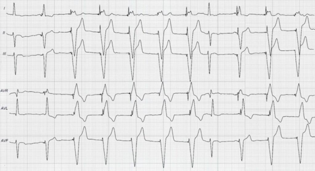 Topic - One-Chamber Pacemaker | 12-Lead ECG Certification Course | ACLS ...