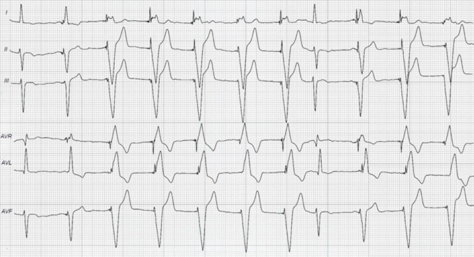 Topic - One-Chamber Pacemaker | 12 Lead ECG Course | ACLS Certification ...