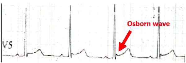 Topic - The ST Segment | 12 Lead ECG Course | ACLS Certification Association