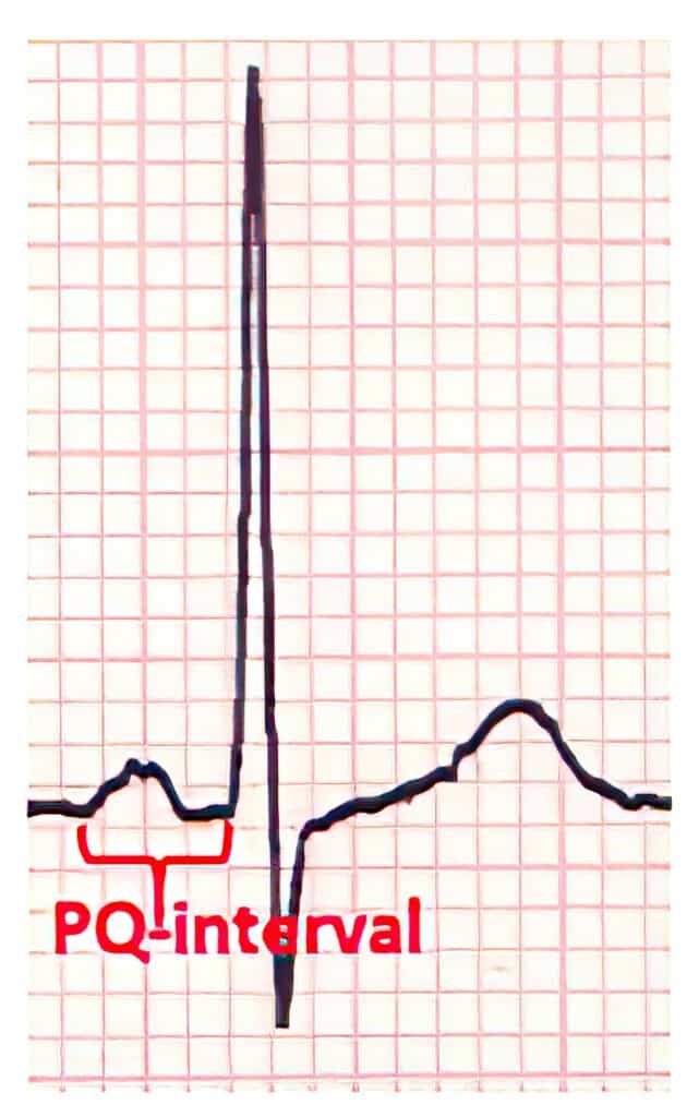 Topic - PQ Interval | 12-Lead ECG Certification Course | ACLS ...