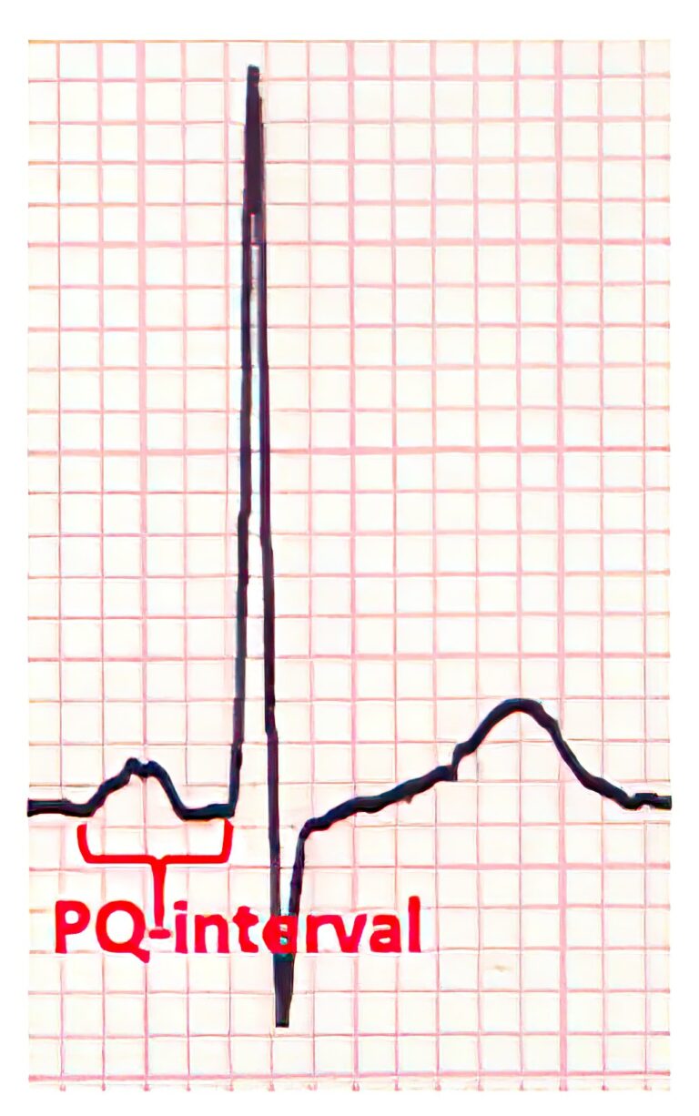 Topic - PQ Interval | 12-Lead ECG Certification Course | ACLS ...
