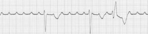 Topic - Atrial Tachycardias | 12-Lead ECG Certification Course | ACLS ...