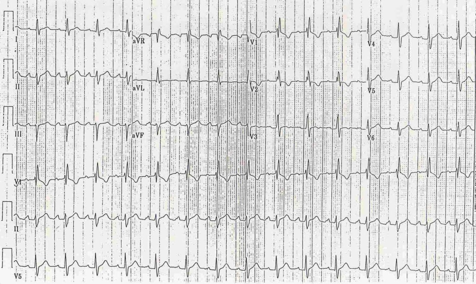Topic - Atrial Septal Defect (Ostium Primum) | 12-Lead ECG ...