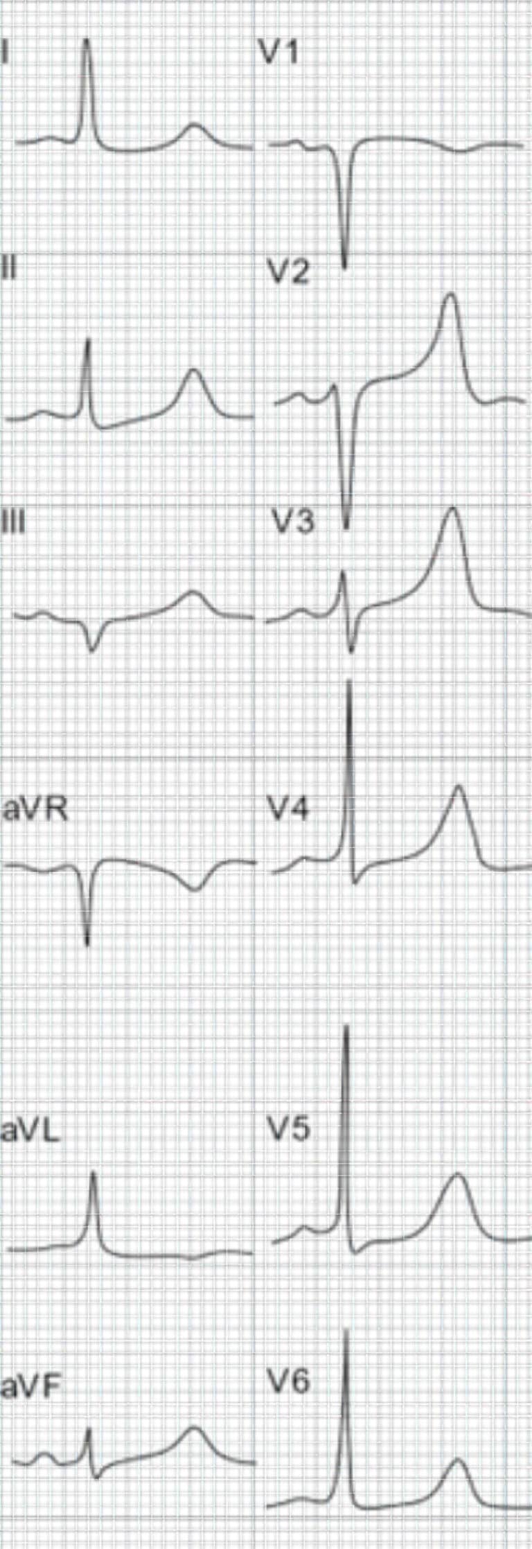 Topic - Hypocalcemia | 12 Lead ECG Course | ACLS Certification Association