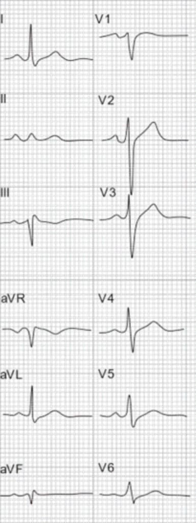 Topic - Hypercalcemia | 12-Lead ECG Certification Course | ACLS ...