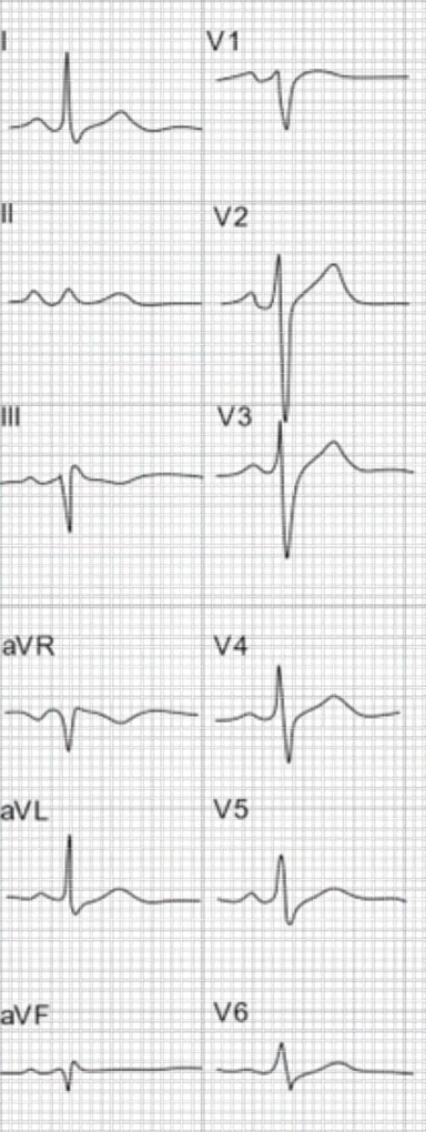 Topic - Hypercalcemia | 12-Lead ECG Certification Course | ACLS ...