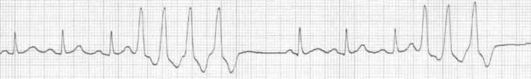 Topic - Premature Ventricular Contractions Nomenclature | 12-Lead ECG ...