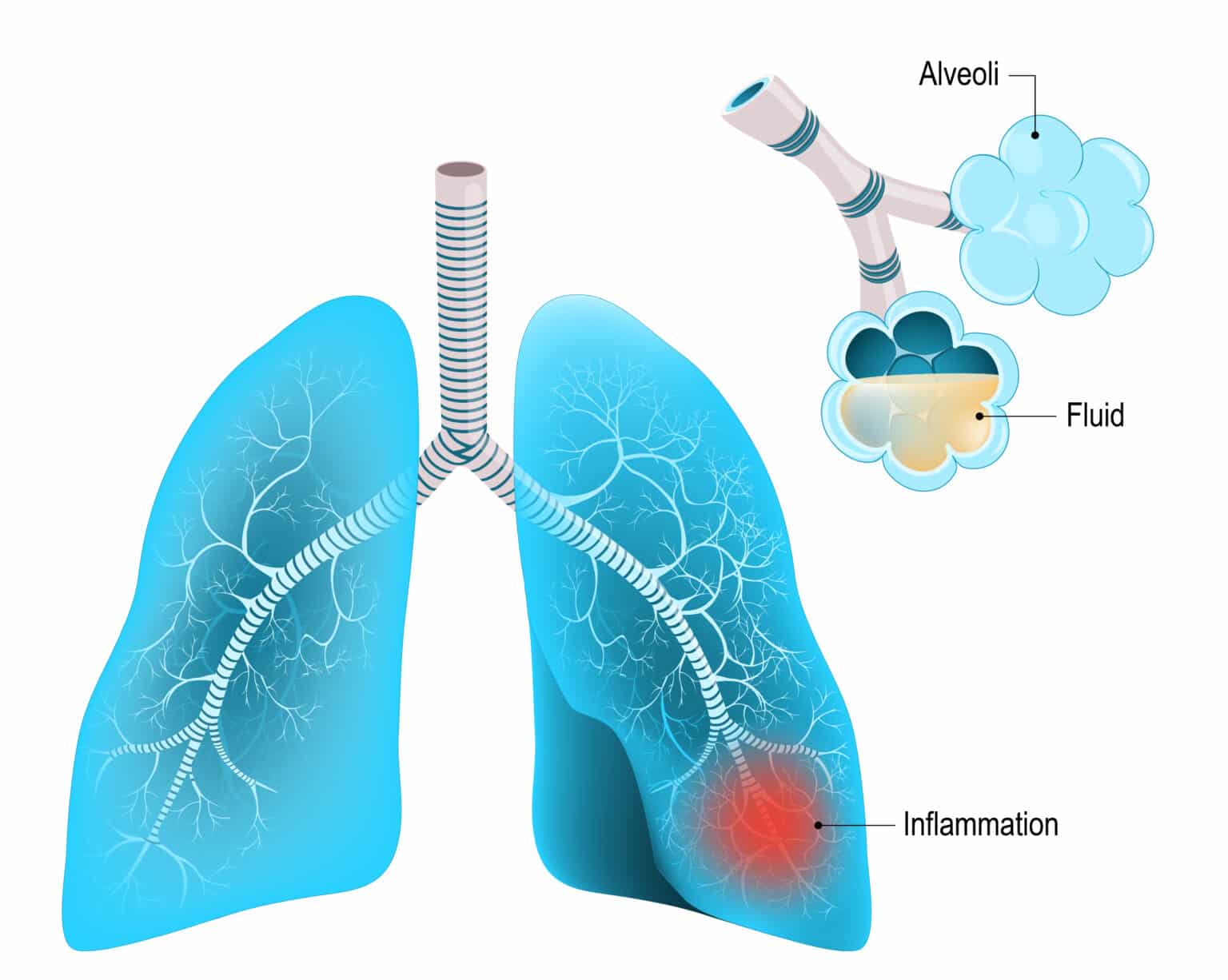 Topic - Conditions Associated With Respiratory Problems | PALS Course ...