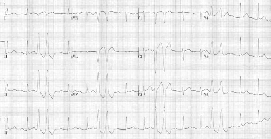 Topic - Premature Ventricular Contractions Nomenclature | 12 Lead ECG ...