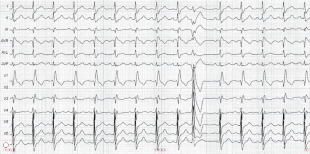 Topic - Morphology and Origin | 12-Lead ECG Certification Course | ACLS ...