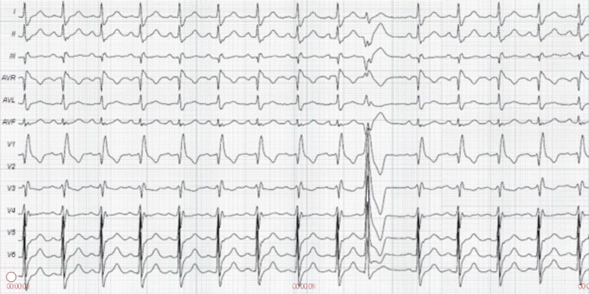 Topic - Morphology and Origin | 12 Lead ECG Course | ACLS Certification ...
